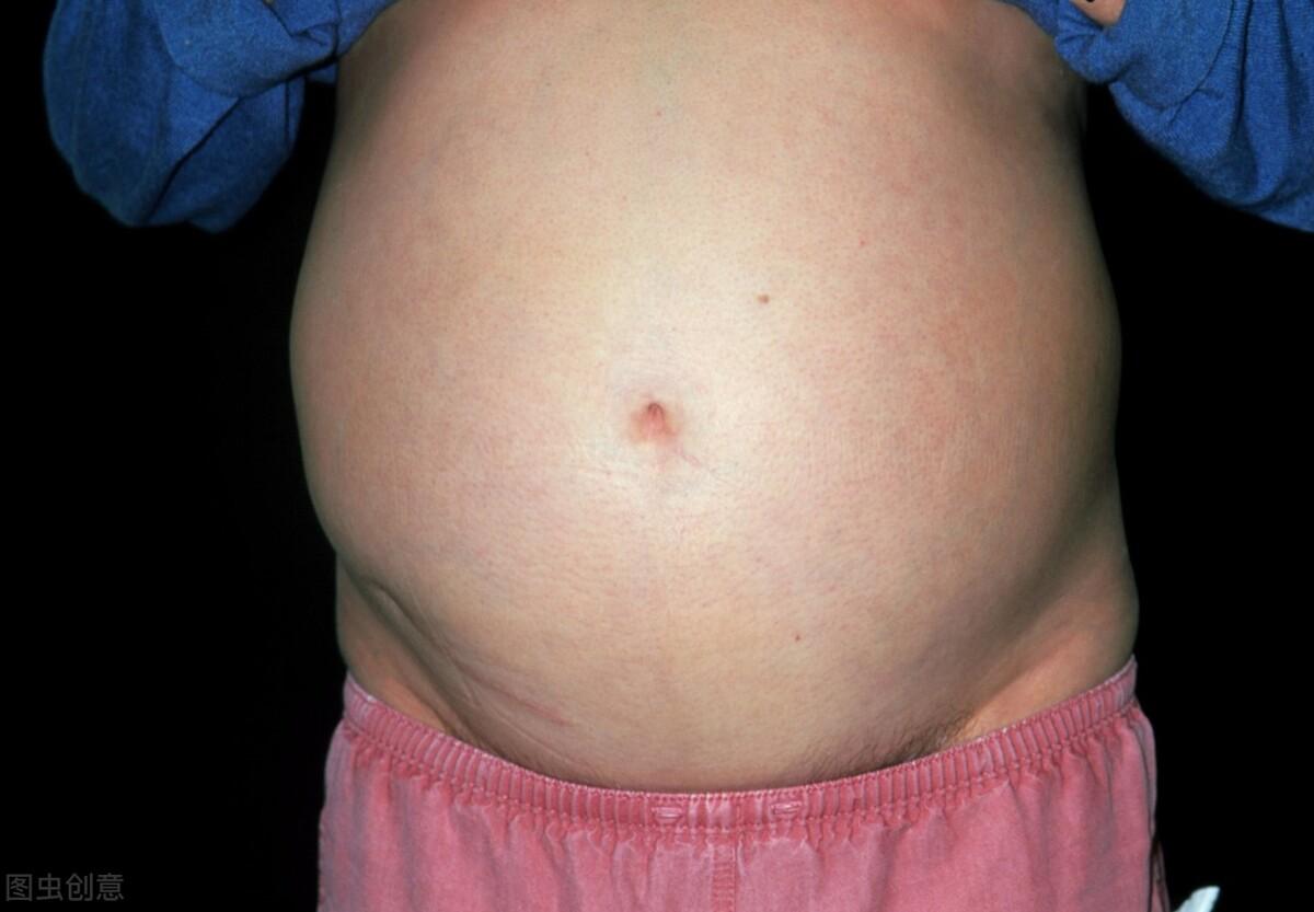 Liver cirrhosis, ascites, stomach bloating, so uncomfortable!There is ...