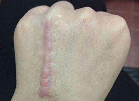 Why does the hyperplastic scar recur after treatment? - iNEWS