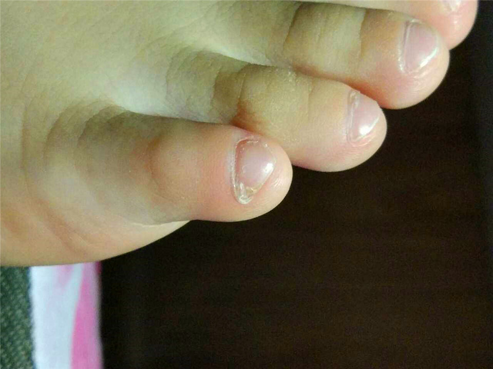 What is the origin of people who split their little toenails in two?Are ...