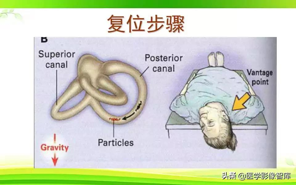 How to differentiate and diagnose "central positional vertigo" that is ...