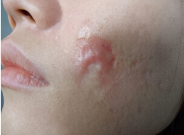 The fading process of scar hyperplasia.Will the scar hyperplasia fade ...