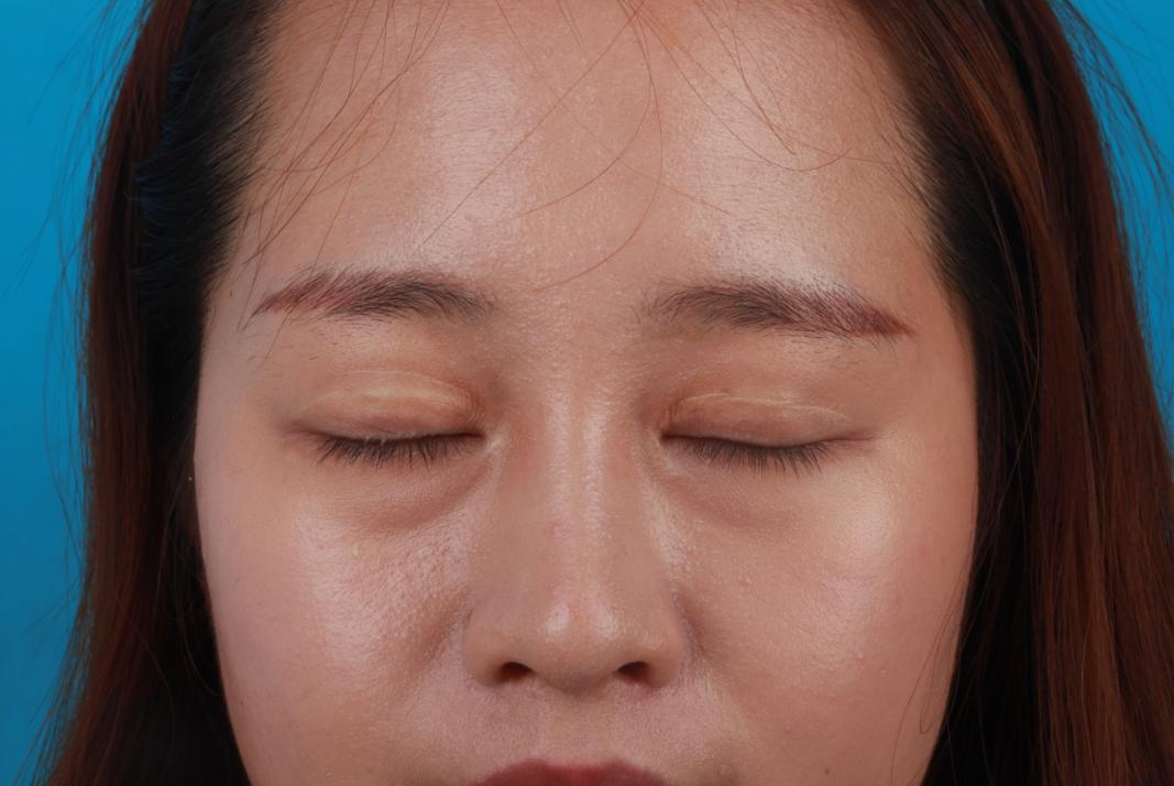 How to reject postoperative scar hyperplasia? - iNEWS