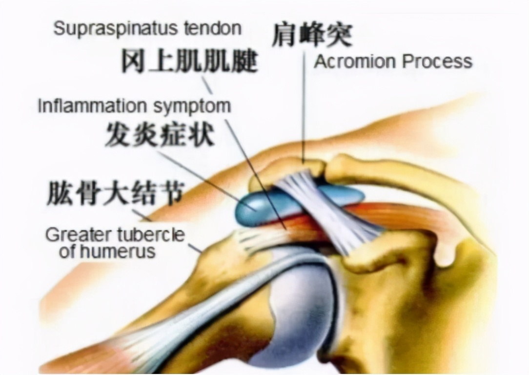 Several important principles of shoulder joint exercise rehabilitation ...