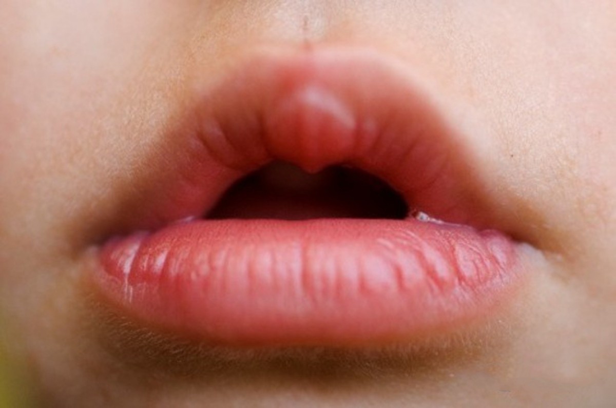 What should I do if my child has chapped lips, peeling and bleeding?The ...