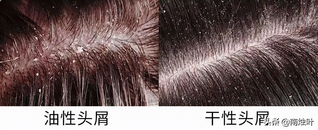 Why do people have dandruff?Excessive dandruff may have these effects ...