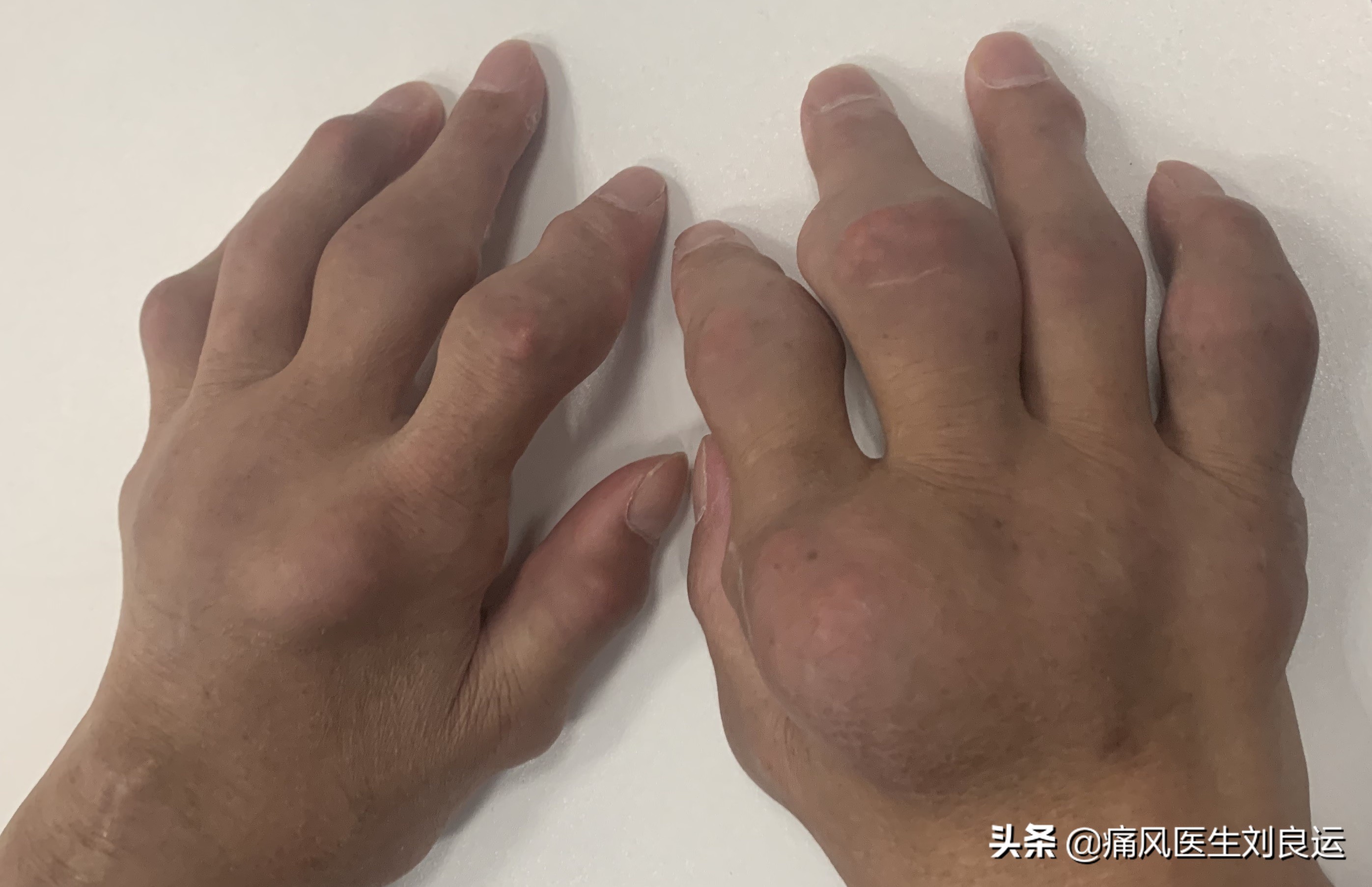 Worried about tophi after a gout attack? Dr. Liu: Do three things to ...