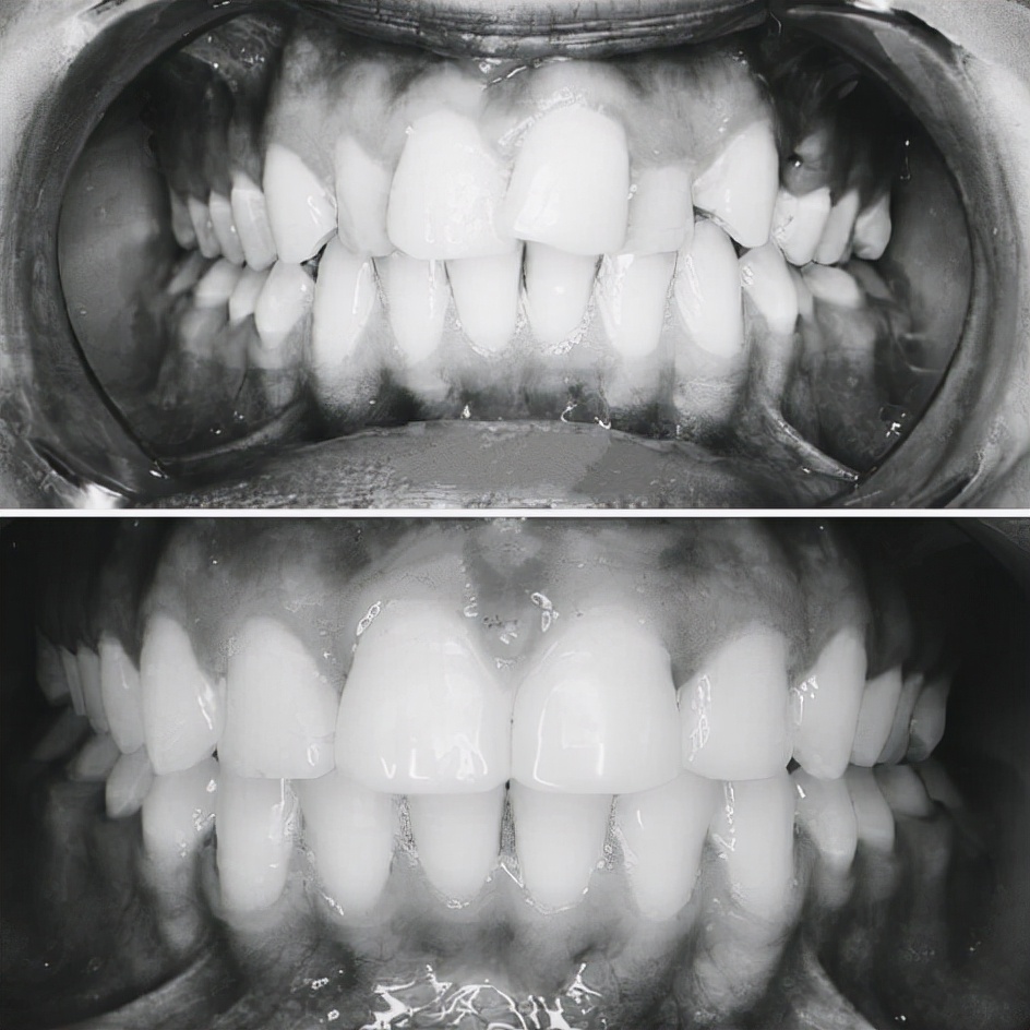 You must know the top three causes of crowded teeth - iNEWS