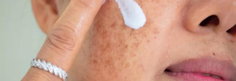 Can chloasma be cured? Relapse is more difficult? You must see these ...