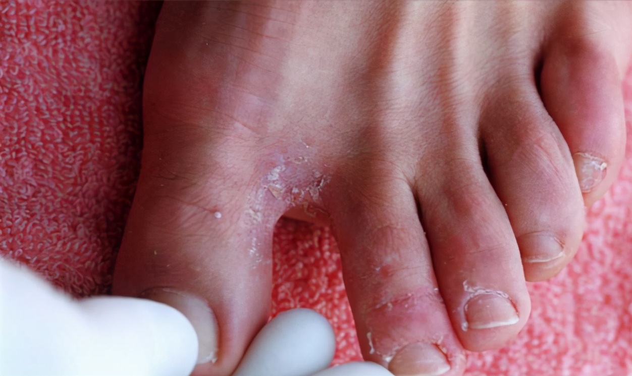 Rotten toe blisters, thick heel, doctor diagnosed: mixed athlete's foot ...