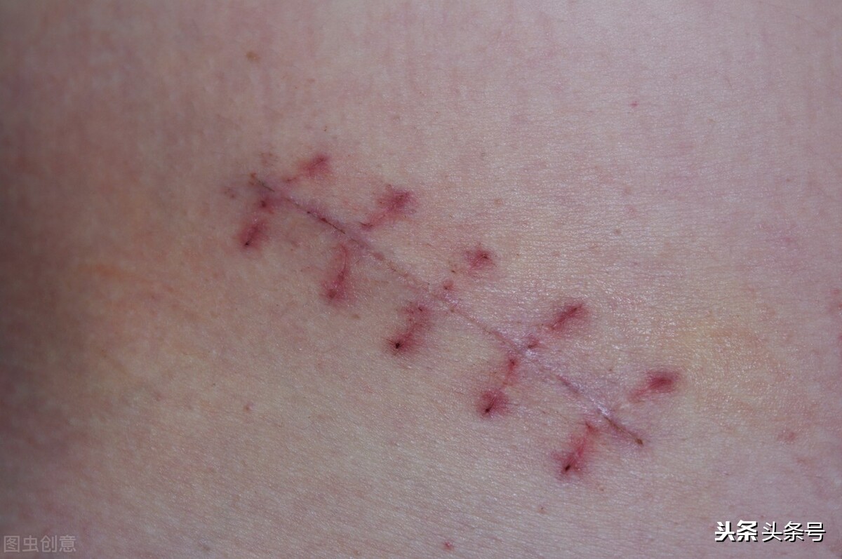 What is the redness of the wound after the scab is gone?These points to ...