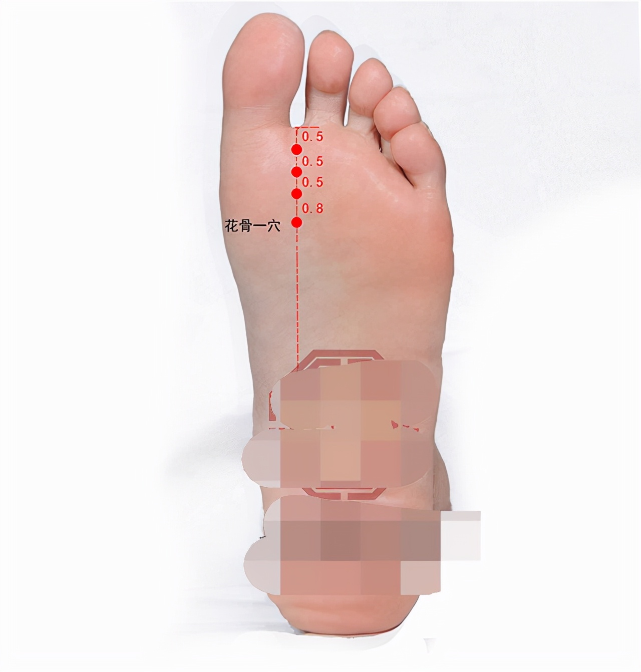 TCM acupuncture upper extremity disease prescription 2 - iNEWS