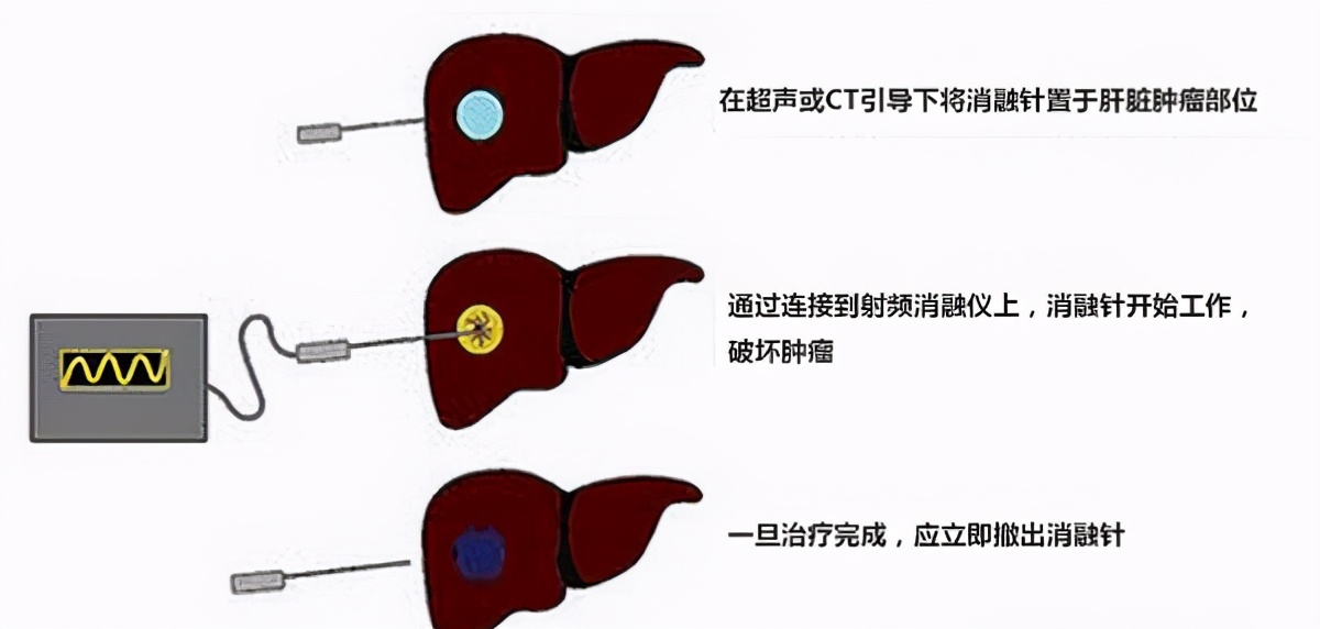 High temperature "scalding" cancer cells has been proven to be ...