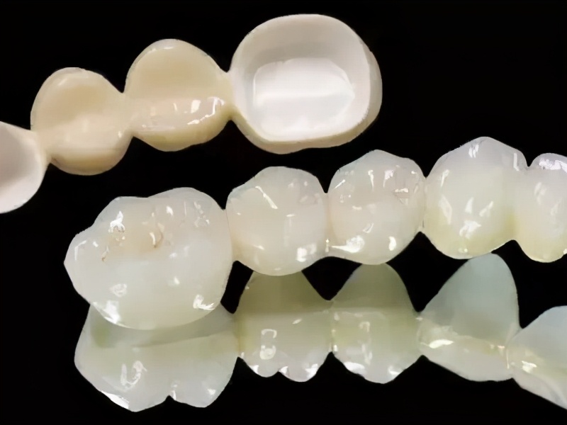 Is there any difference between porcelain teeth and all porcelain teeth ...