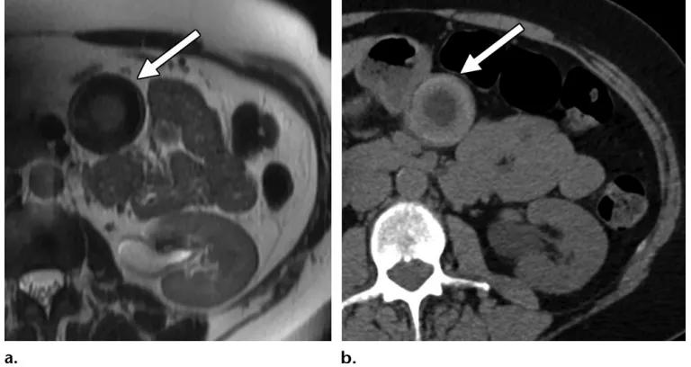 Calcification in the abdominal and pelvic cavity?These differential ...