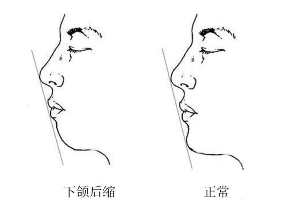 No matter how delicate the facial features are, and the chin is not ...