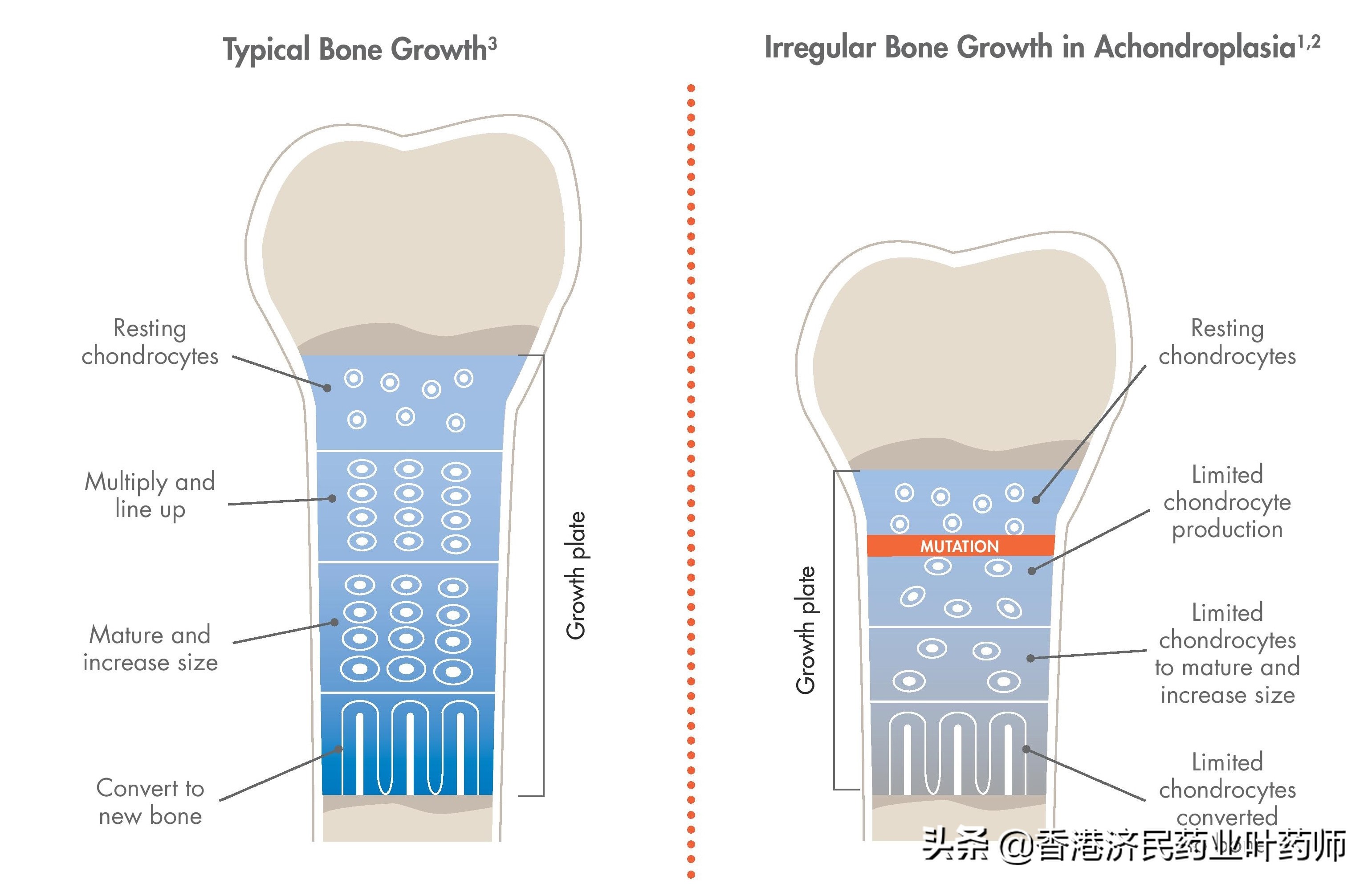 Treatment of achondroplasia from 2 years old until the growth plate is ...