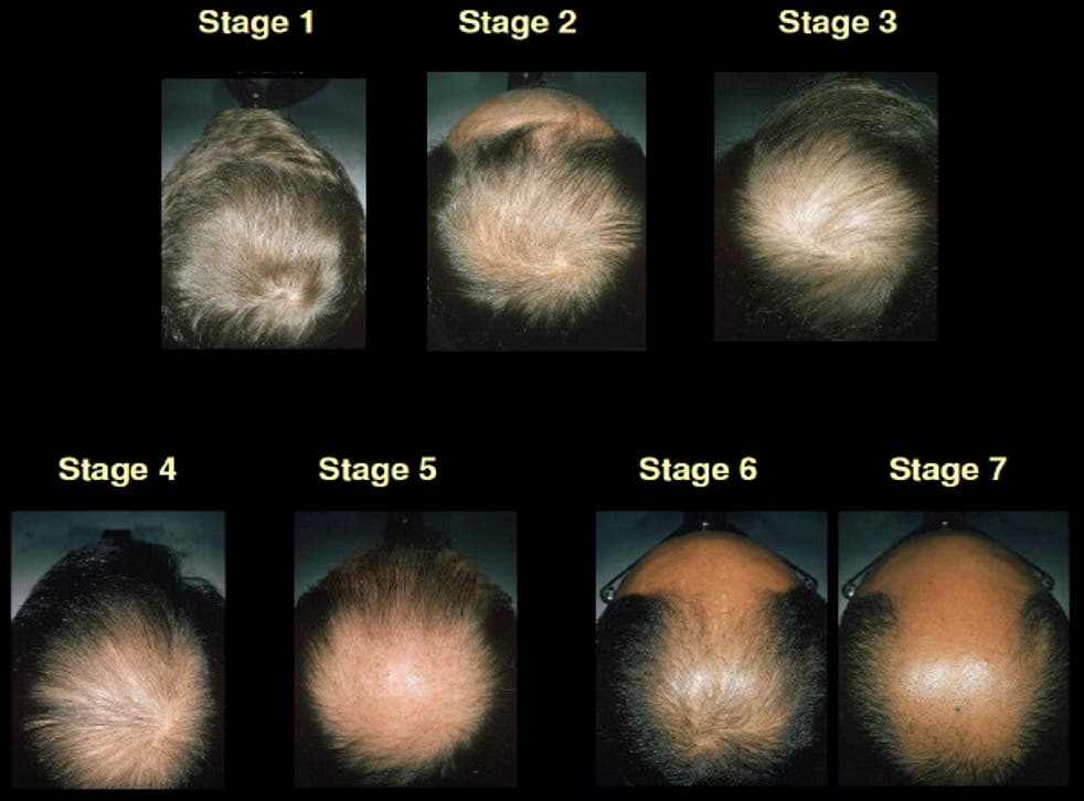 In Europe, 9 out of 10 people are bald. They have no choice but to coat ...