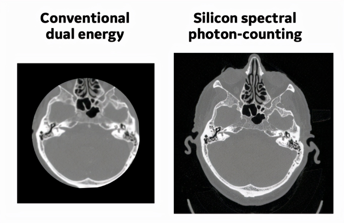 The world's first deep silicon detector!GE Photon Counting CT Enters ...