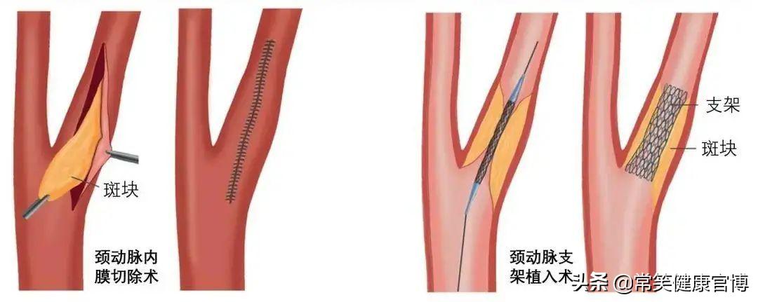 Do you really know stroke?What is the difference between CTA and CT ...