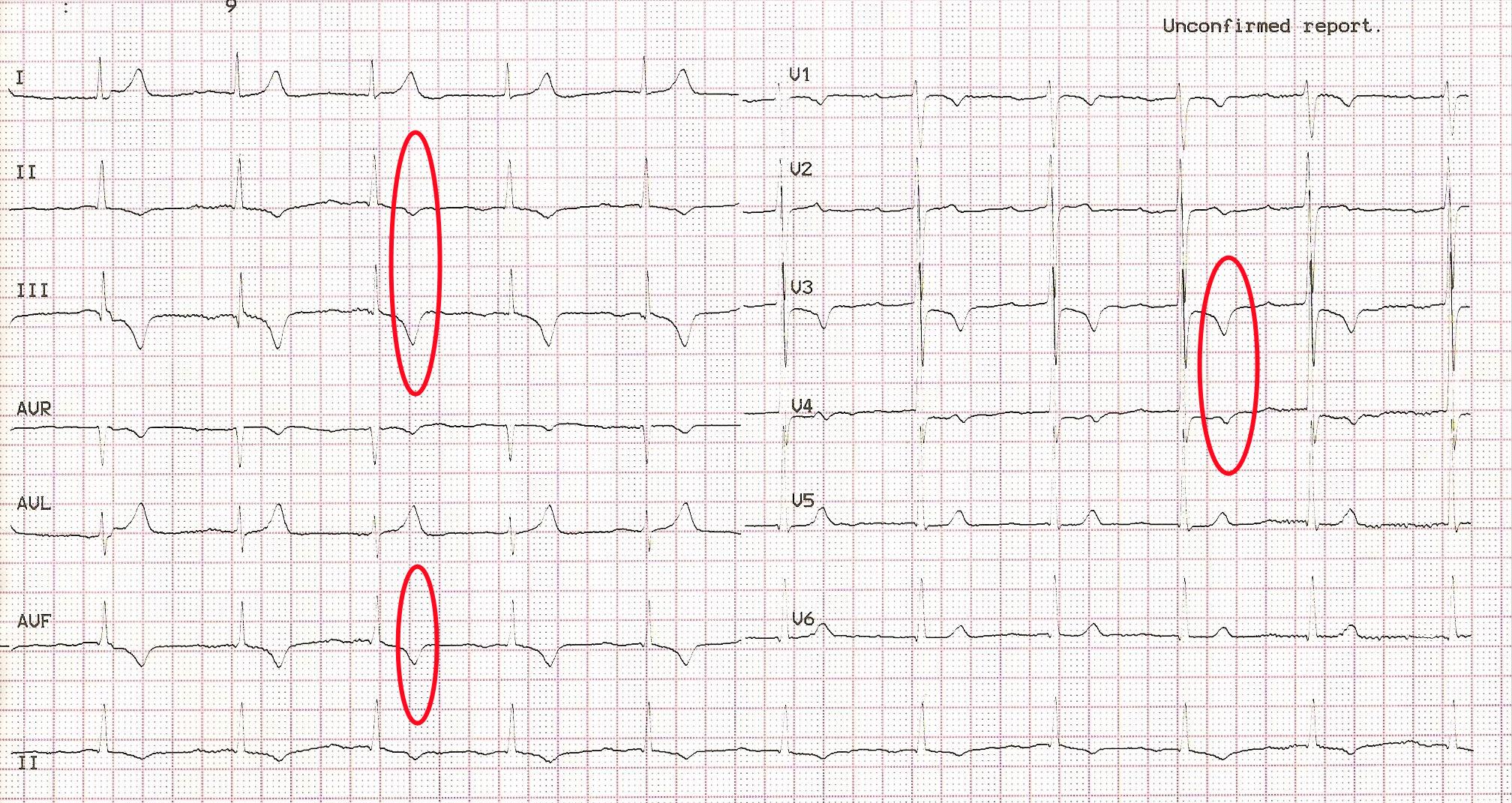 What is the change in the T wave of the electrocardiogram?Is it ...