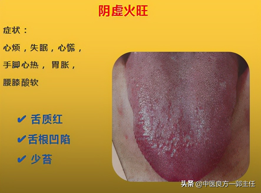 12 kinds of "heat" are hidden in the body, and the tongue and symptoms ...