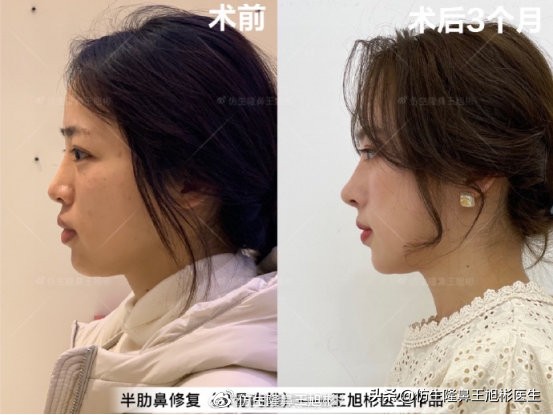 What is a box nose?Can a rhinoplasty doctor make a natural and advanced ...