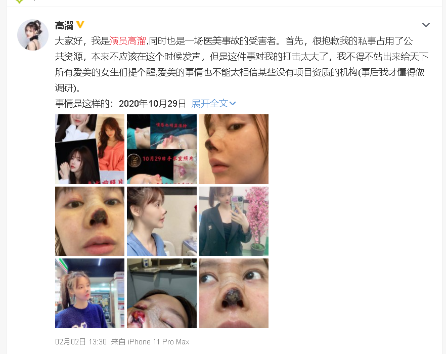 The young actress Gao Liu failed to undergo plastic surgery, her nose ...