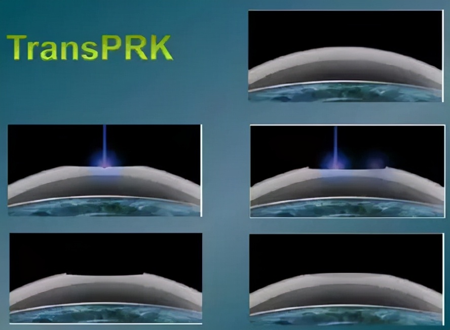 How to choose myopia surgery?You will understand everything after ...