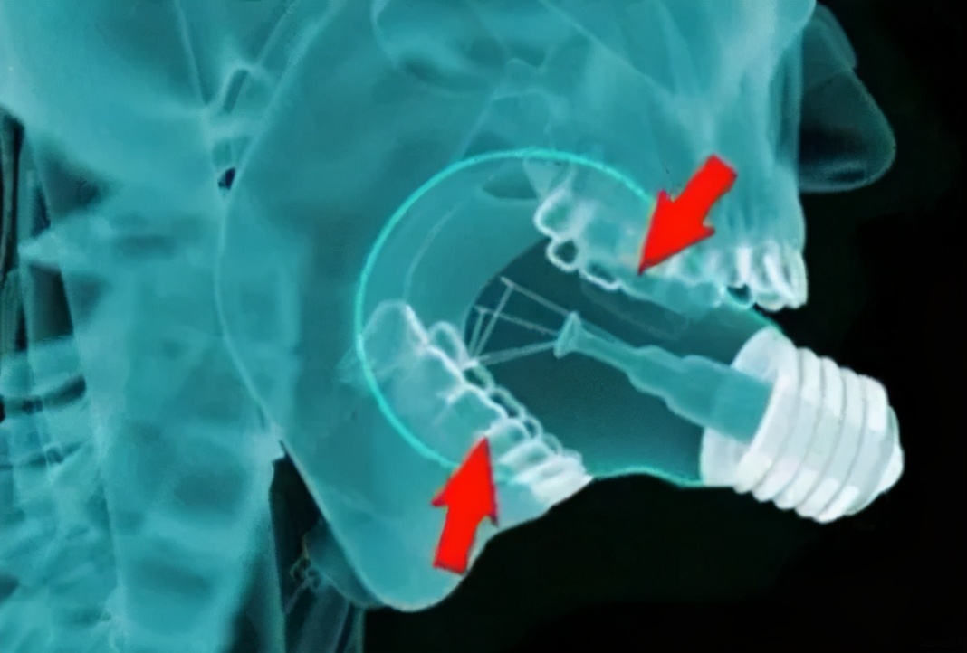Why can't the light bulb be swallowed in but not pulled out? - iNEWS