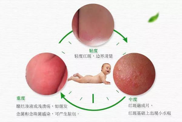 Baby has red buttocks and red buttocks repeatedly?Yuesao can solve it ...