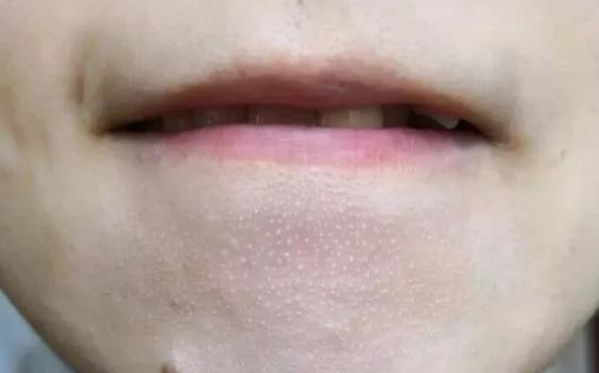 There are many small white particles on the chin. What is it? Teach you ...