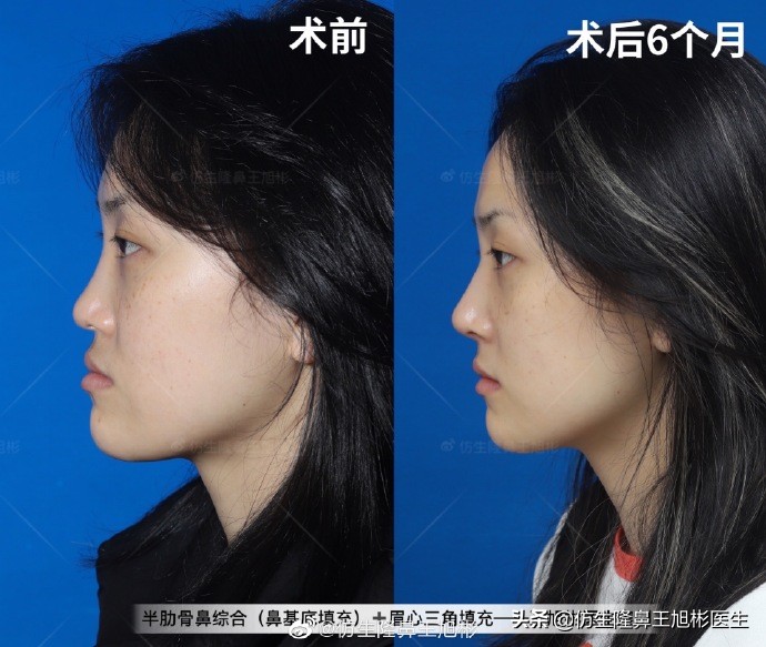 "Doctor, can the sunken face be improved without nasal base filling ...