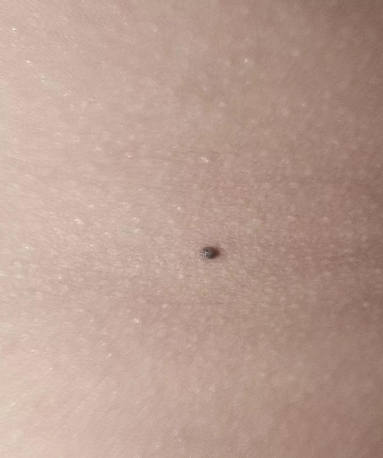 Don't mess with the little black spots on your child - iNEWS