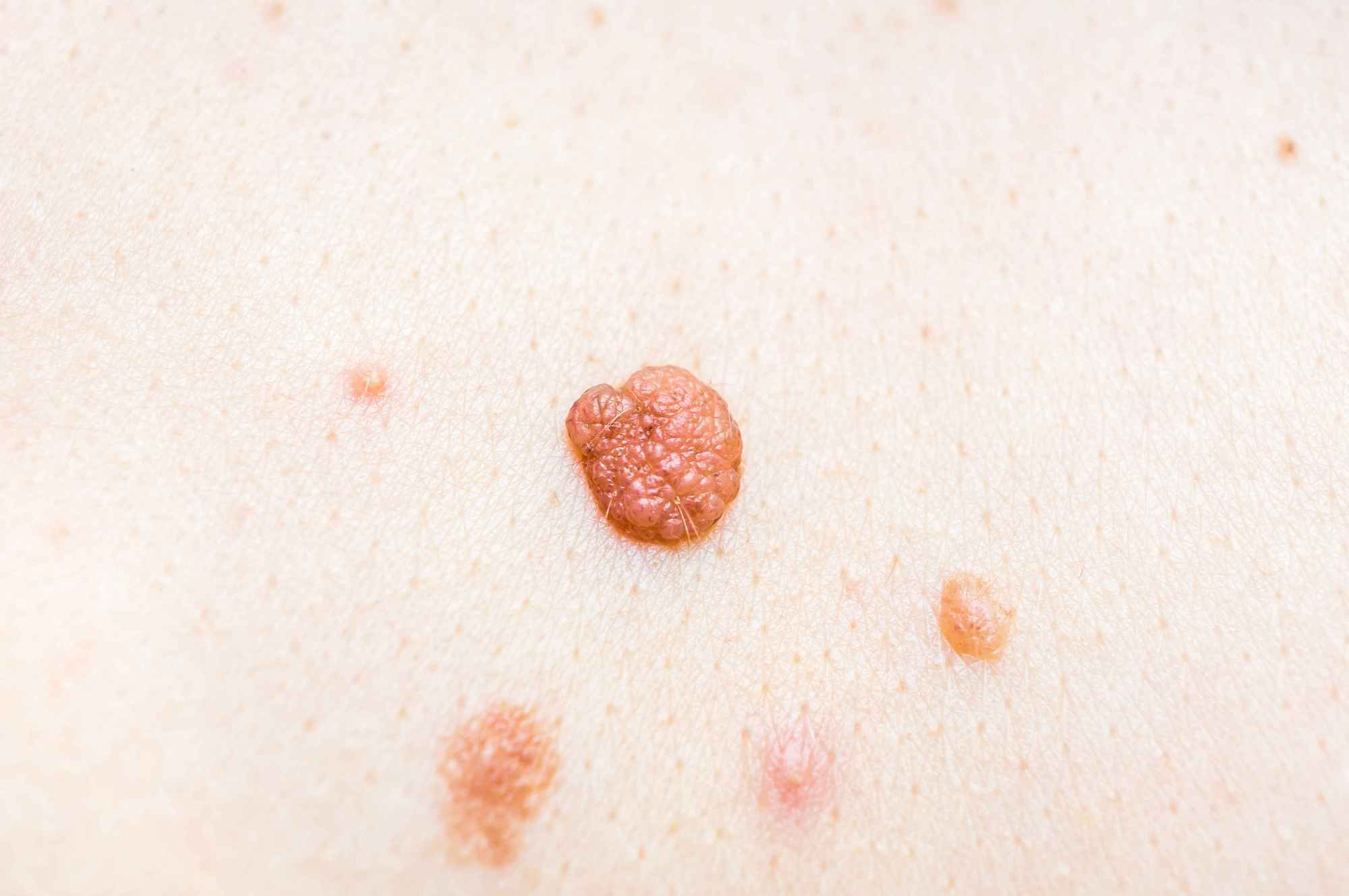 careful!Flat warts can be contagious, and two common treatments in ...