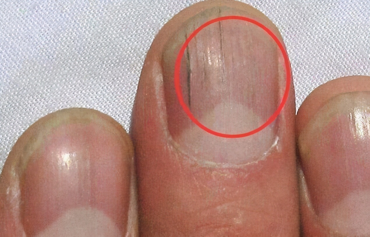 Vertical lines appear on the nails, not just stripes?Expert: It may be ...