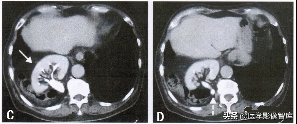 Imaging diagnosis of ectopic thoracic kidney - iNEWS