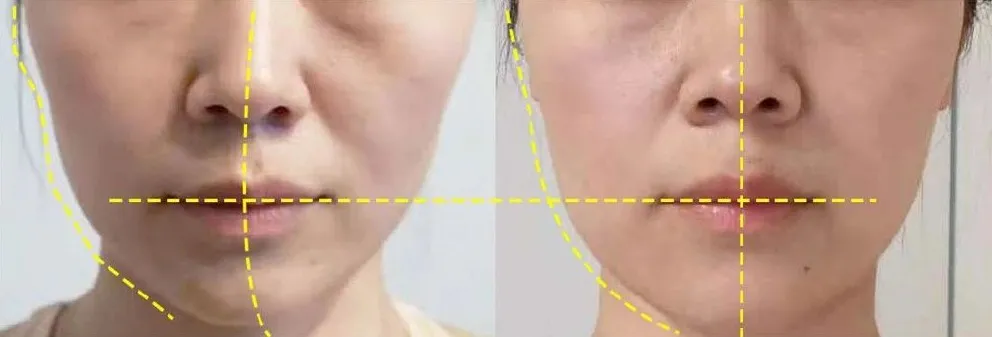 "Save the protruding cheekbones and return to the girl's face" How can ...