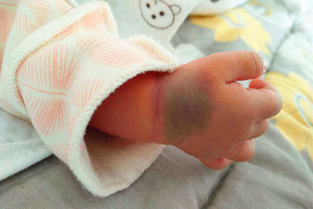 The newborn has a "bruise", is it beaten? Don't worry, this is a ...