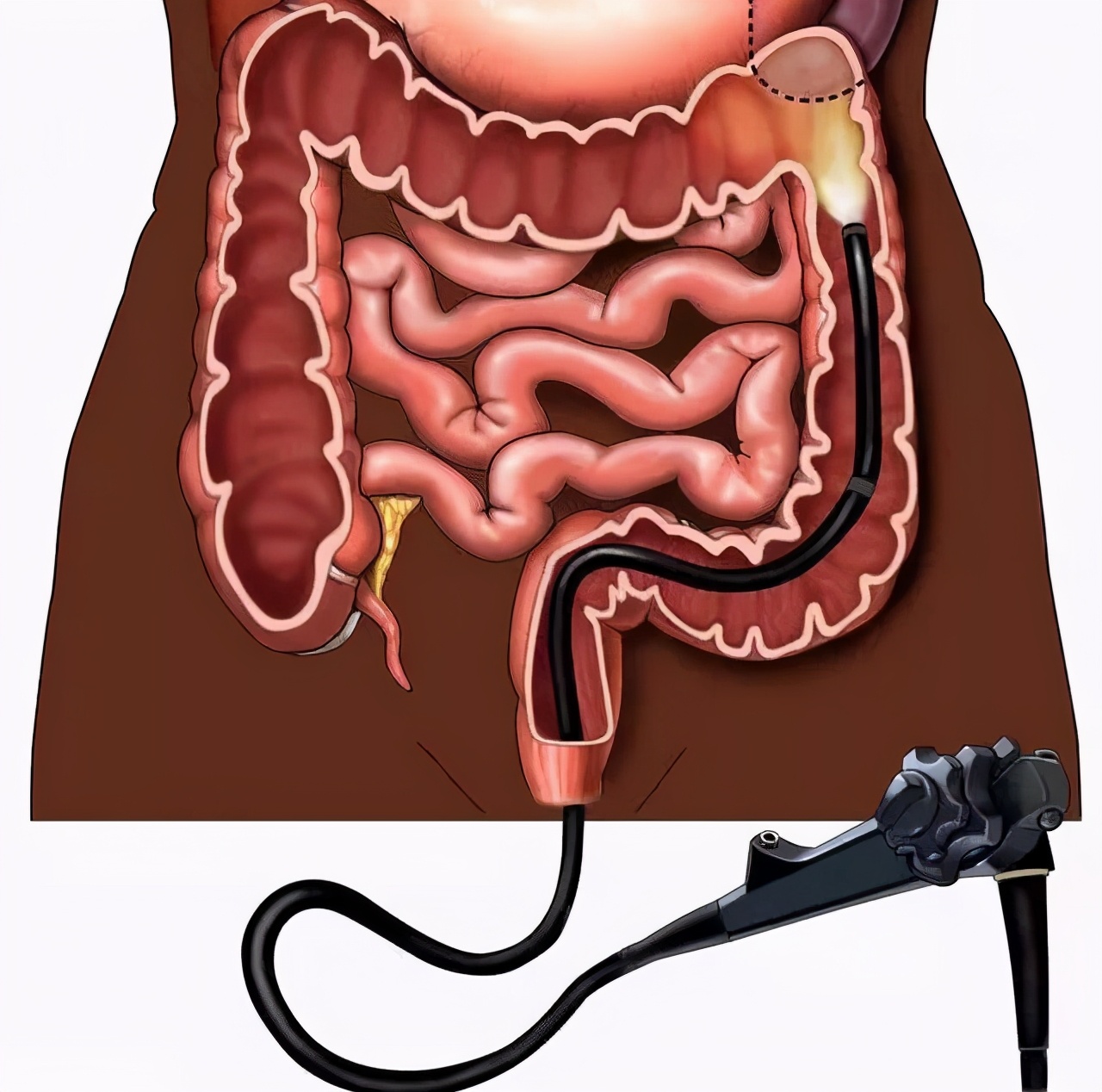 Is it really painless to do colonoscopy better than ordinary?Listen to ...