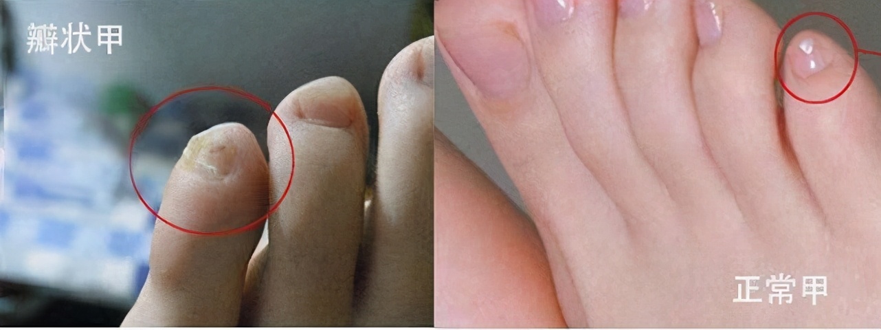 Where do people with split little toe nails come from? - iNEWS