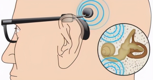 What is a bone conduction hearing aid?Who is suitable for bone ...