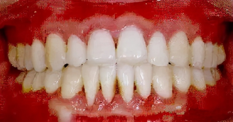 Orthodontics professor Tsai Note: How much do you know about sliced ...