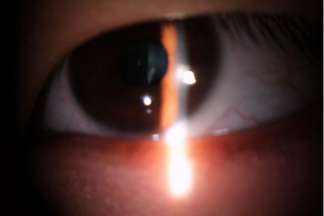 Professor Jolia: Diagnosis and treatment of early-onset high myopia - iNEWS