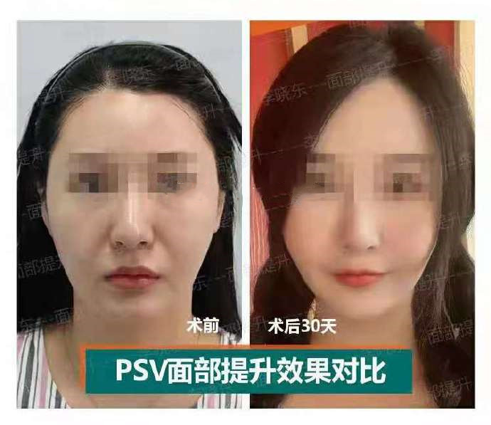What is the difference between PSV face lift and face lift?Where is the ...
