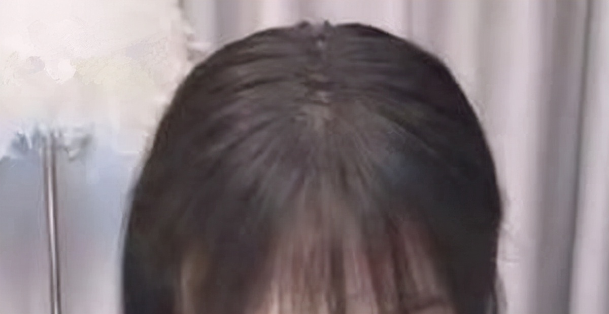 Is hair gap width considered hair loss?Can it be restored? - iMedia