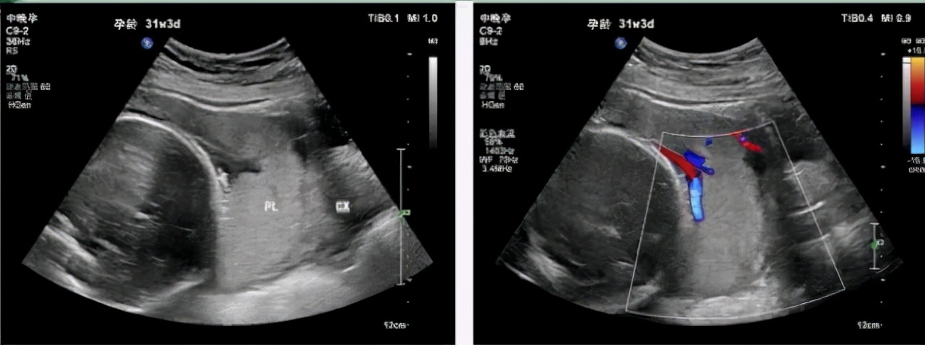 Diagnosis of placenta previa, ultrasound examination is essential - iMedia