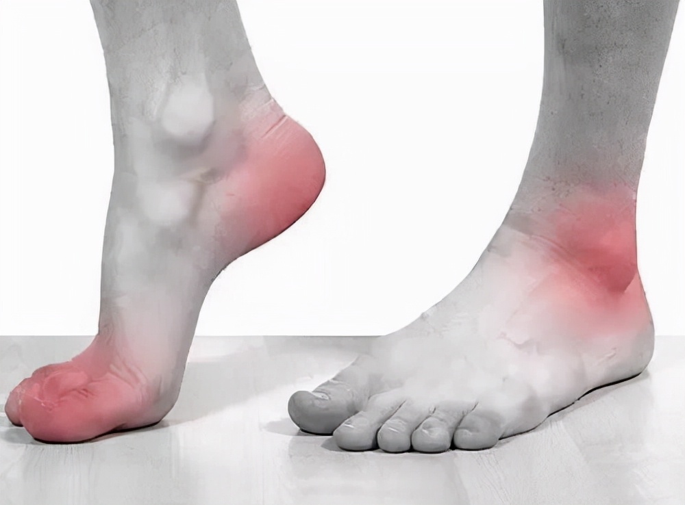 Where does the gout stone grow?What should I do if I have tophi?The ...