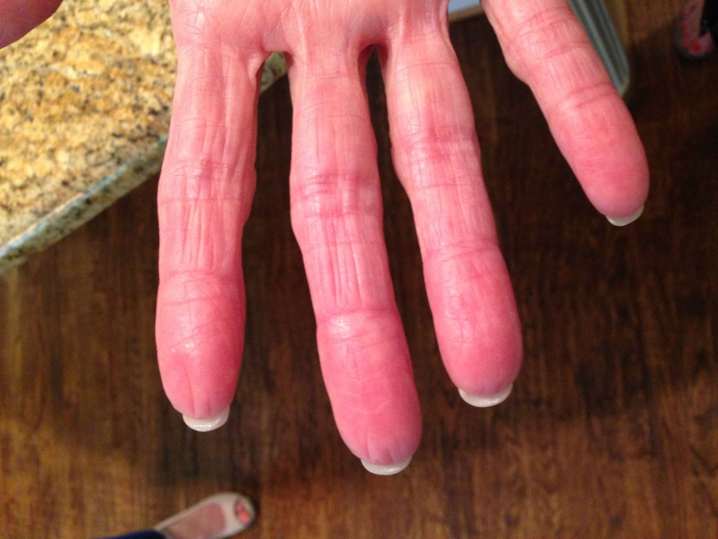 Why do some people have no fingerprints? - iNEWS