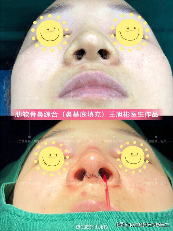 "Hook nose" is fierce and old, how to correct it? - iNEWS