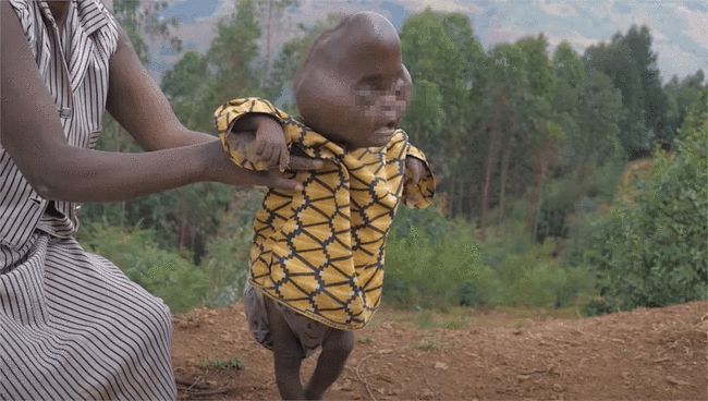 A strange baby in Rwanda, Africa, with a triangular head resembling an ...
